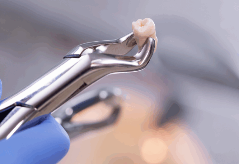 Key Benefits of Tooth Extraction